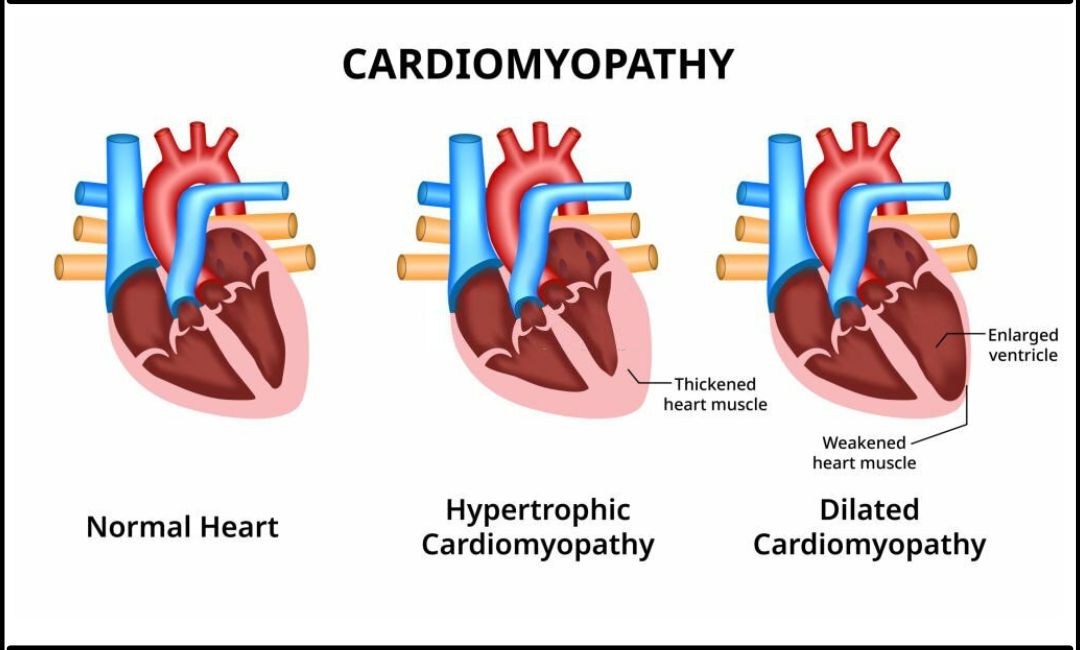 What Are The Main Types Of Cardiomyopathy Infoupdate What Are The Main Types Of Cardiomyopathy Infoupdate