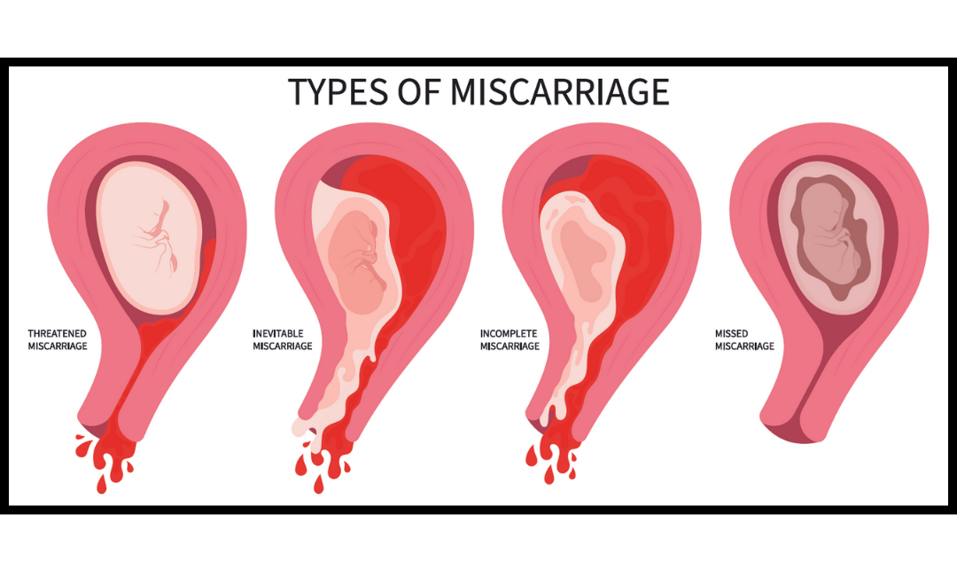 Miscarriage Causes Risk Factors Symptoms Treatment