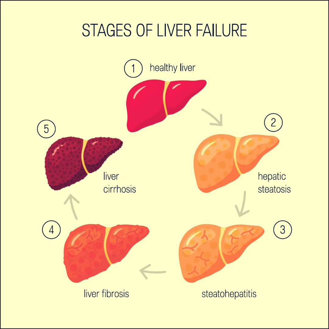 Liver Failure Causes Risk Factors Symptoms Treatment